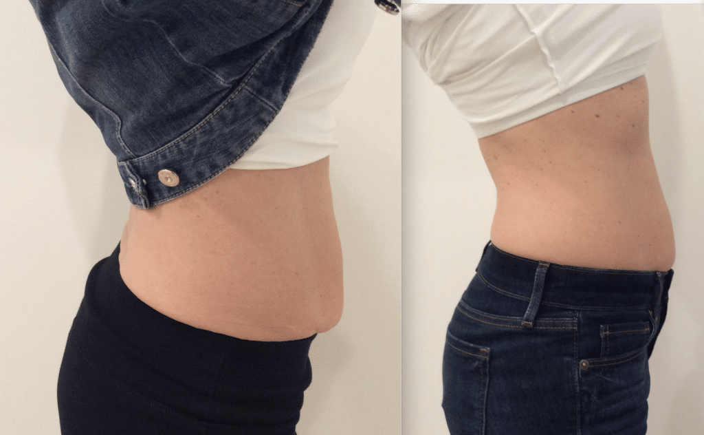 Fat & Cellulite Reduction with Acoustic Sound Wave Therapy | Chill ...