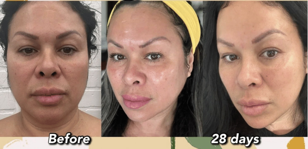 Nanoneedling... A Revolution in Anti Aging Skin Treatment! - Chill ...